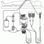 De ontwikkeling van de Mechanische ondersteuning van het hart - LVAD