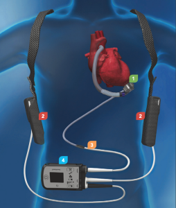 HeartMate 3 - LVAD